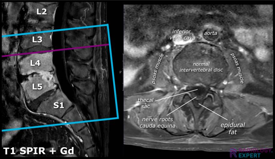 MRI Lumbar Spine