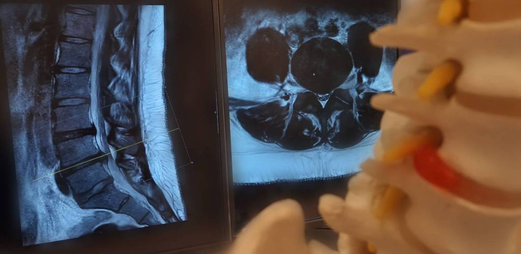 MRI Lumbar Spine