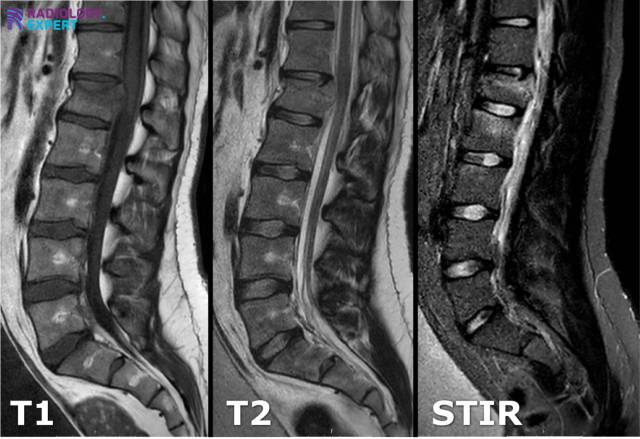 MRI Lumbar Spine