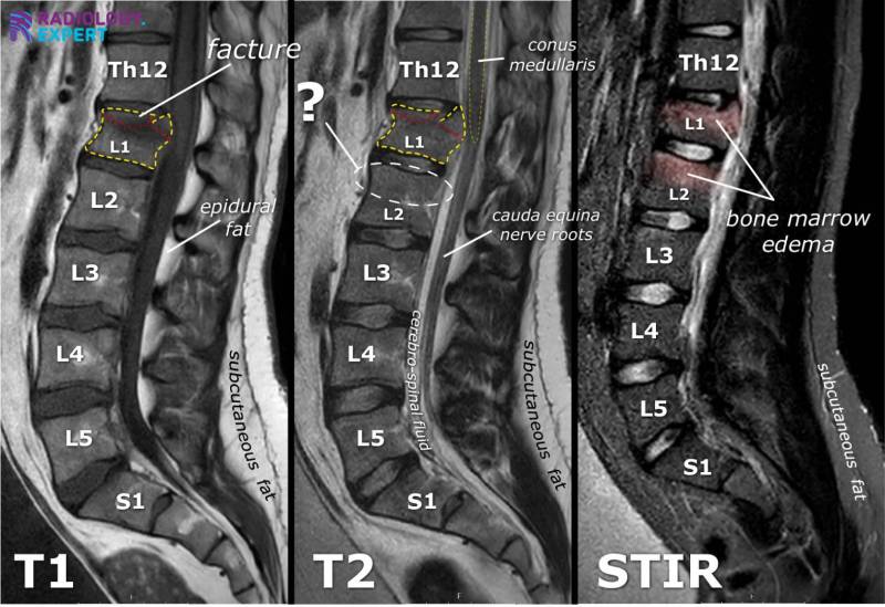 MRI Lumbar Spine