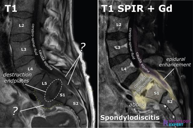 MRI Lumbar Spine