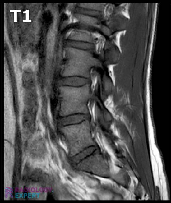MRI Lumbar Spine