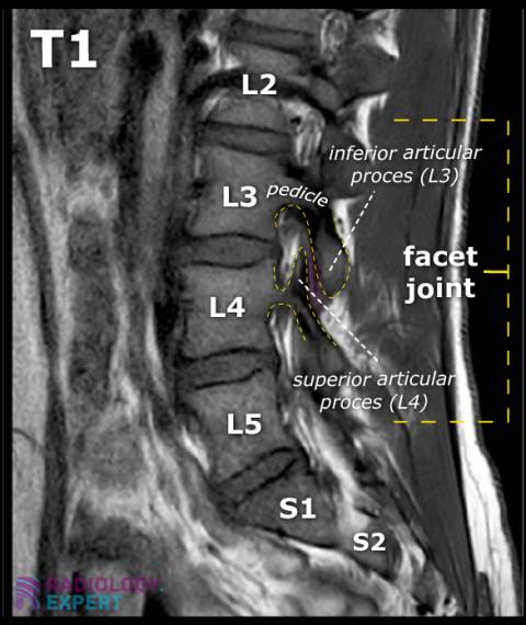 MRI Lumbar Spine