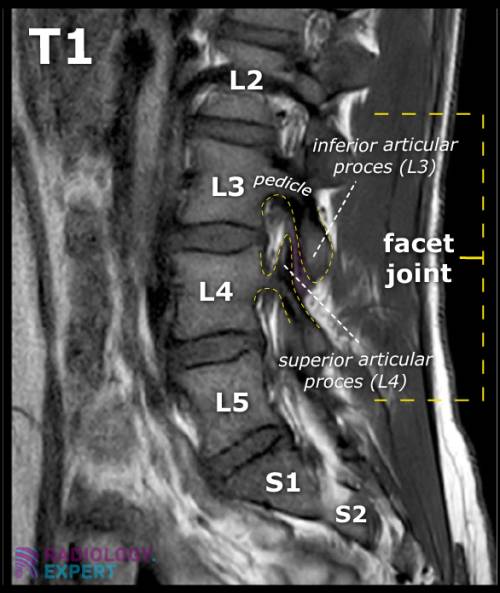 MRI Lumbar Spine