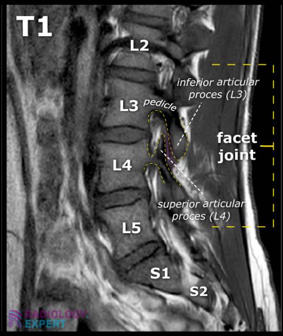 MRI Lumbar Spine
