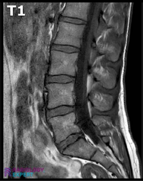 MRI Lumbar Spine