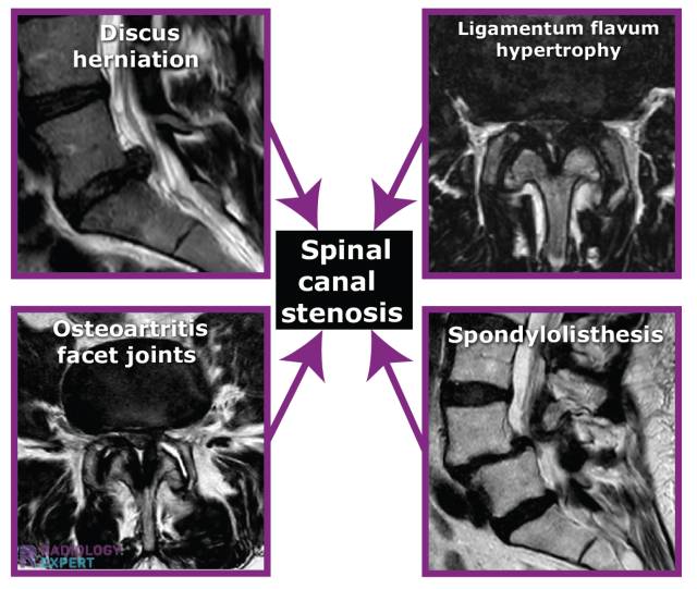 MRI Lumbar Spine