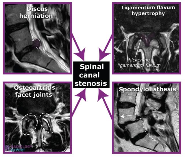 MRI Lumbar Spine