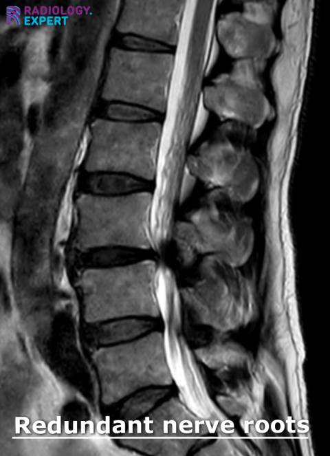 MRI Lumbar Spine
