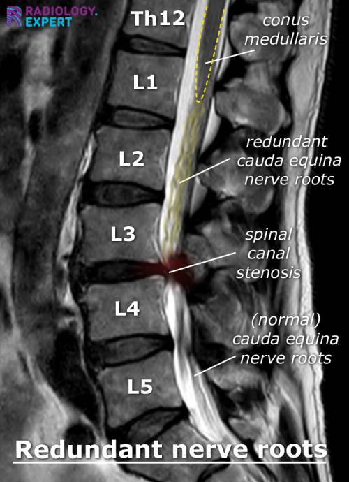 MRI Lumbar Spine