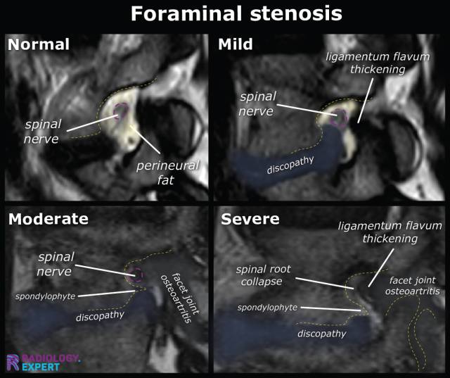 MRI Lumbar Spine