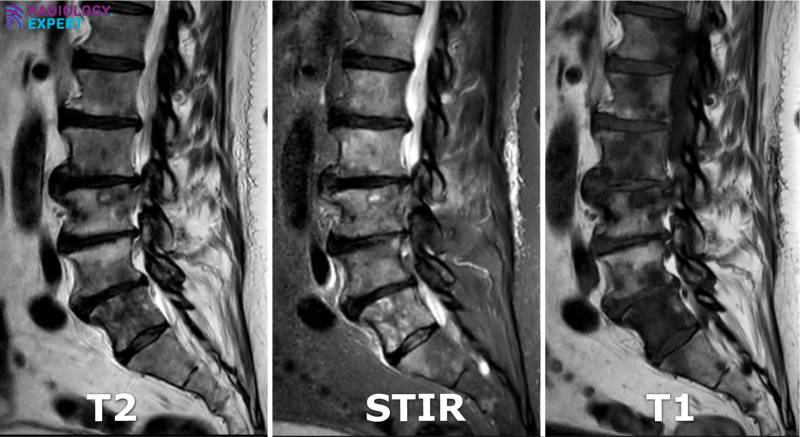 MRI Lumbar Spine