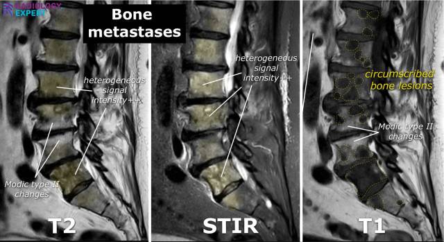 MRI Lumbar Spine