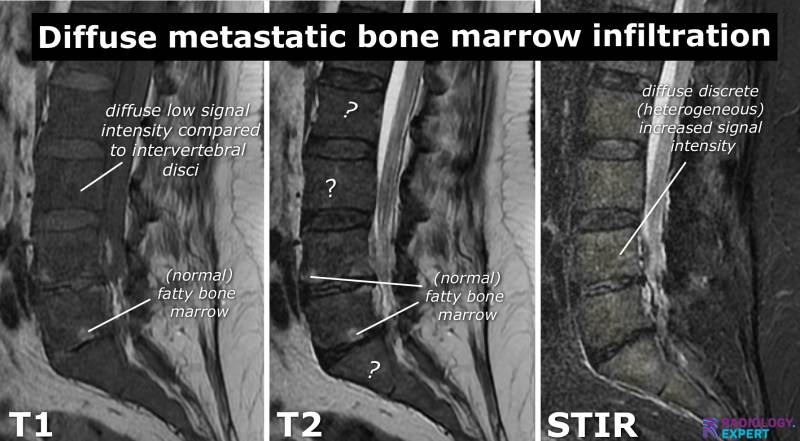 MRI Lumbar Spine