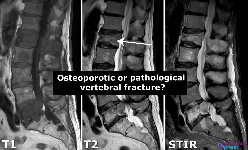 MRI Lumbar Spine