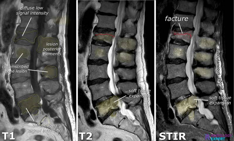 MRI Lumbar Spine