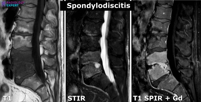 MRI Lumbar Spine
