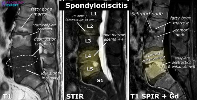 MRI Lumbar Spine
