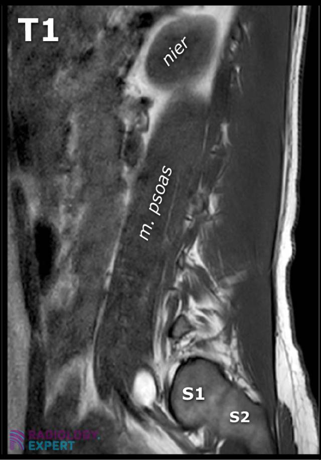 MRI lumbale wervelkolom