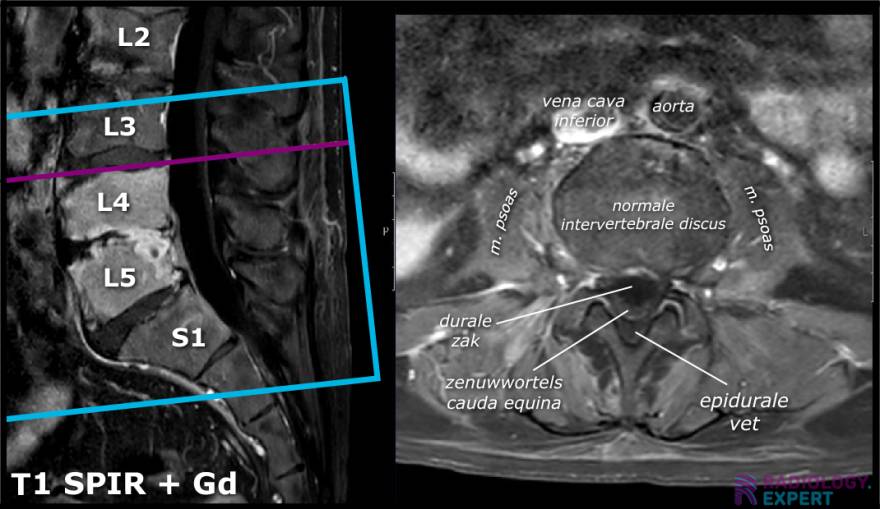 MRI lumbale wervelkolom
