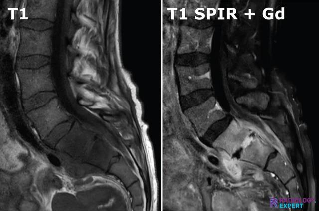 MRI lumbale wervelkolom