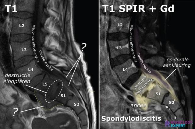MRI lumbale wervelkolom