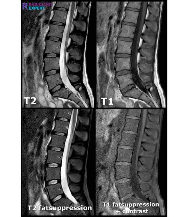 MRI lumbale wervelkolom