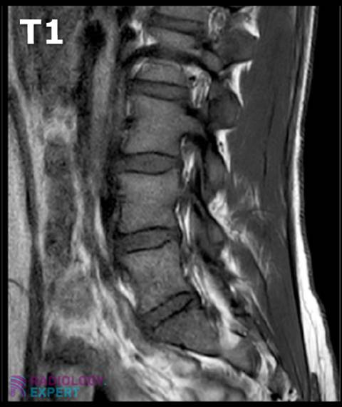 MRI lumbale wervelkolom