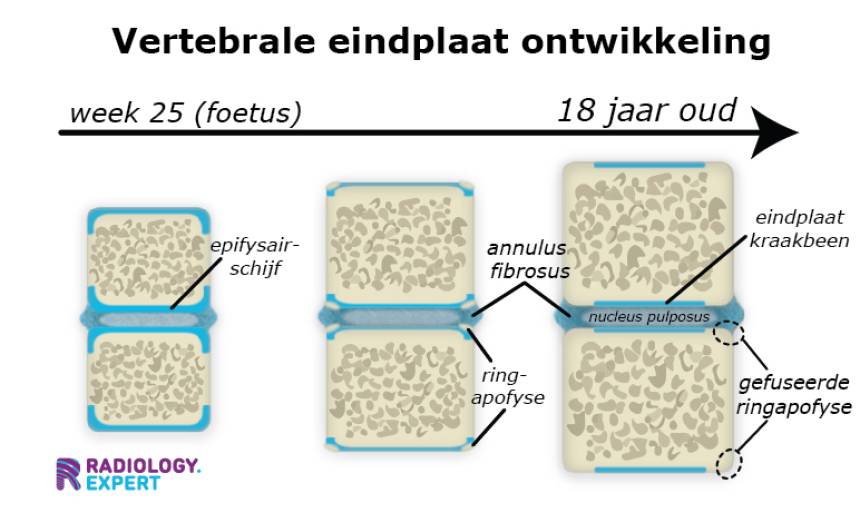 MRI lumbale wervelkolom