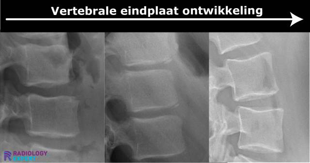 MRI lumbale wervelkolom