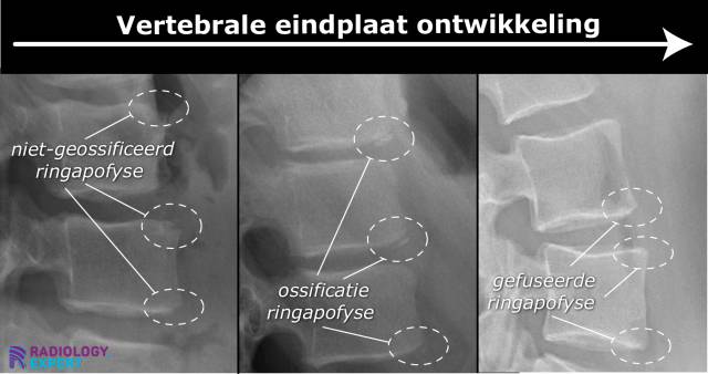 MRI lumbale wervelkolom