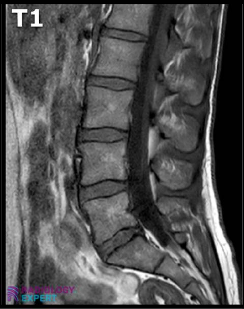 MRI lumbale wervelkolom