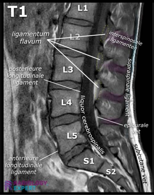 MRI lumbale wervelkolom