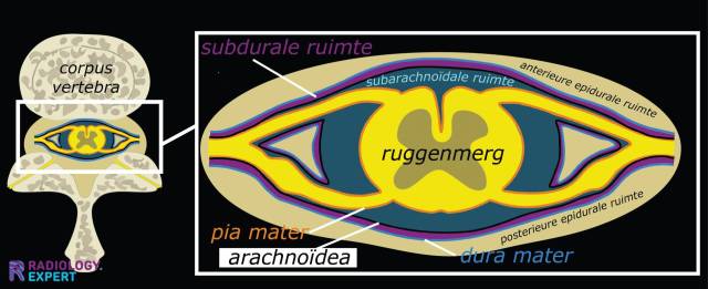 MRI lumbale wervelkolom