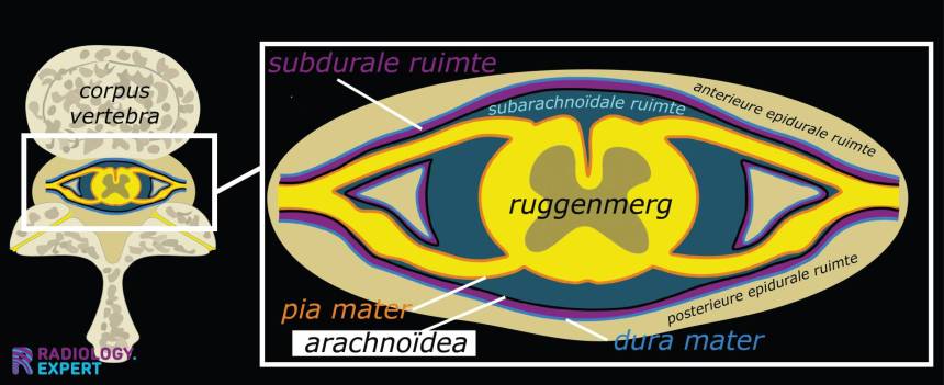 MRI lumbale wervelkolom