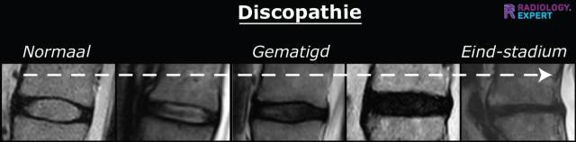 MRI lumbale wervelkolom