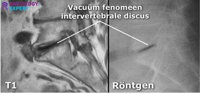 MRI lumbale wervelkolom