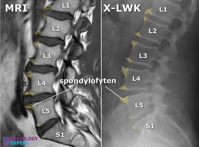 MRI lumbale wervelkolom