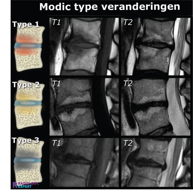 MRI lumbale wervelkolom