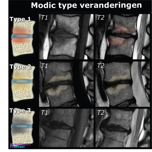 MRI lumbale wervelkolom