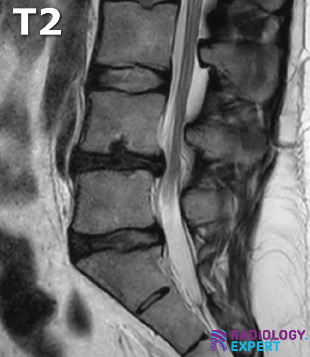 MRI lumbale wervelkolom