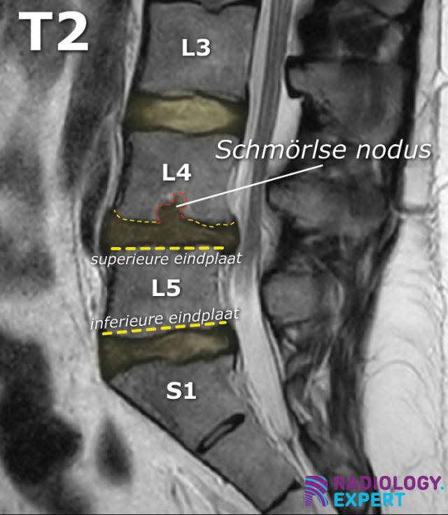 MRI lumbale wervelkolom