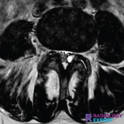 MRI lumbale wervelkolom