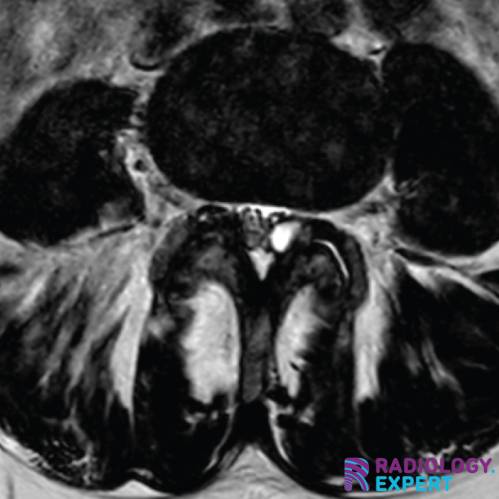 MRI lumbale wervelkolom