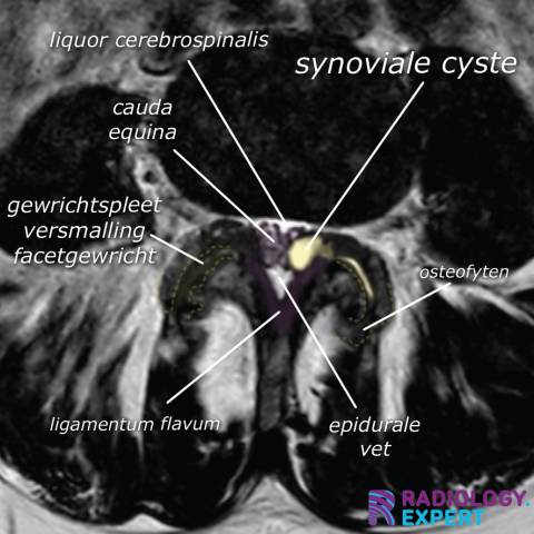 MRI lumbale wervelkolom