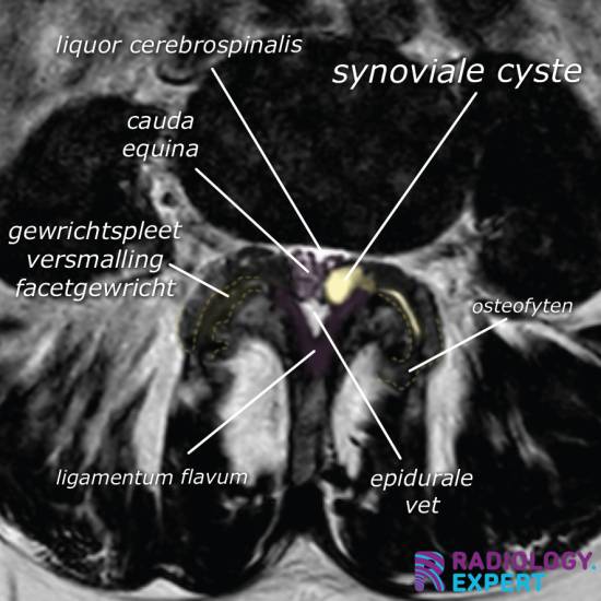 MRI lumbale wervelkolom