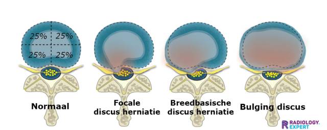 MRI lumbale wervelkolom