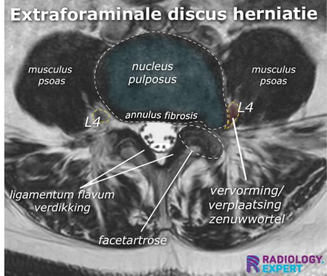 MRI lumbale wervelkolom