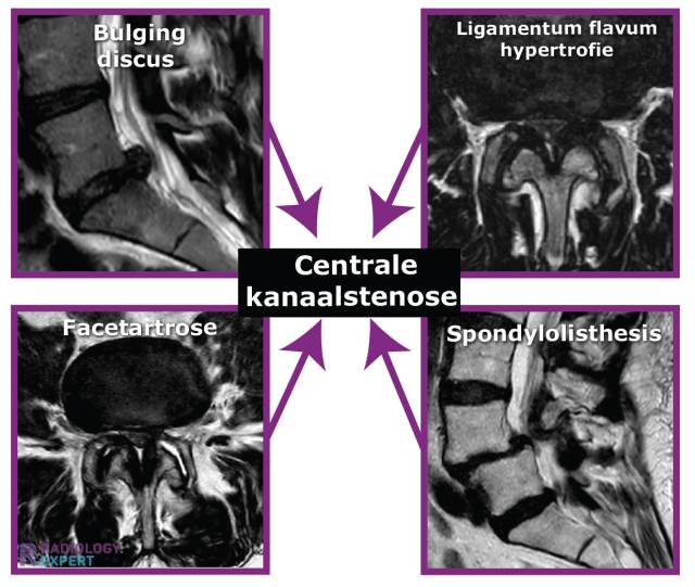 MRI lumbale wervelkolom