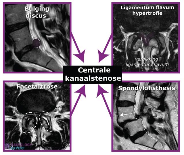 MRI lumbale wervelkolom